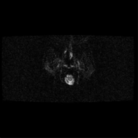 Choroid Plexus Papilloma Radiopaedia 34951 36441 Axial Dwi Nc Commons