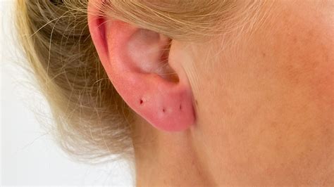 Ear Piercing Cartilage Infection