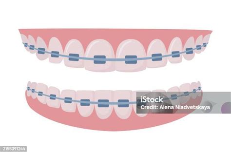 치아에 교정기가 있는 위턱과 아래턱 교정 및 미용 치과 의학 건강한 미소 치과 미백 교정 벡터 건강관리와 의술에 대한 스톡 벡터 아트 및 기타 이미지 Istock