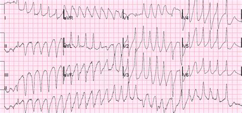 Polymorphic Ventricular Tachycardia Ecg Book Polymorphic Ventricular Tachycardia Ecg Book