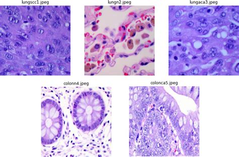Transfer Learning Based Approach For Lung And Colon Cancer Detection