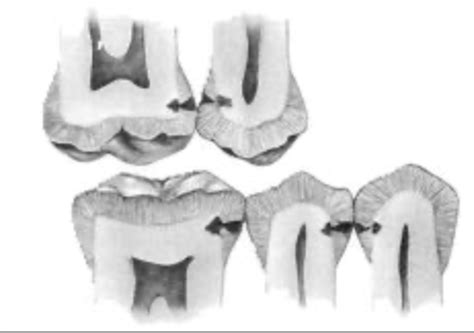 Posterior Composite Class Ii Restorations Flashcards Quizlet