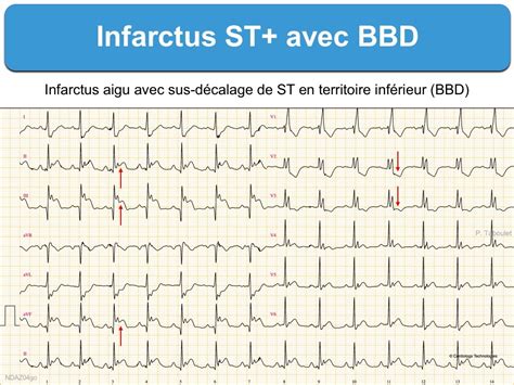 Infarctus 5 BBD E Cardiogram