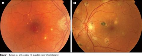 Figure 2 From Punctate Inner Choroidopathy Clinical Features And Outcomes Semantic Scholar
