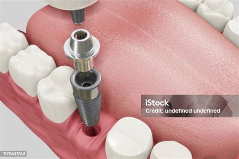 치과 임플란트 치료 절차 의학적으로 정확한 3d 일러스트 틀니 개념 강철에 대한 스톡 사진 및 기타 이미지 강철 건강 진단 건강관리와 의술 Istock