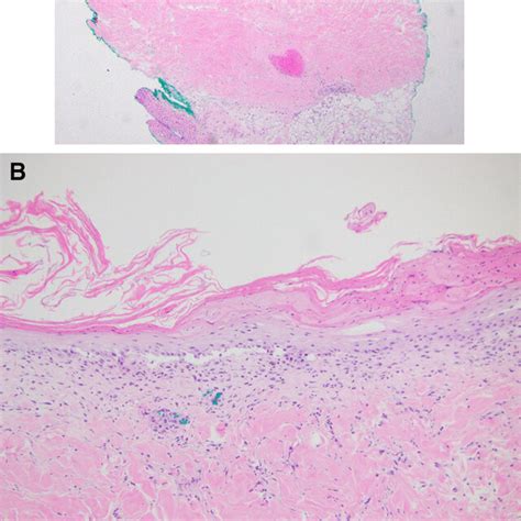Skin Biopsy Demonstrating Vacuolar Interface Dermatitis Ischemic Download Scientific Diagram