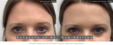 Nyc Daxxify Before And After Ron Shelton M D Patient Photos