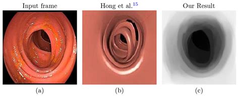 Computer Aided Detection Of Polyps In Optical Colonoscopy Images