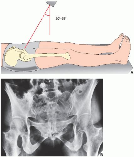 Xray Pelvis Lateral View Download Scientific Diagram