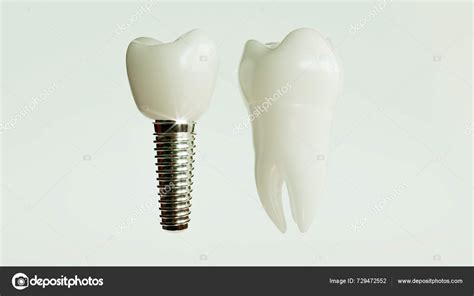 Rendering Compares Dental Implant Its Natural Counterpart Highlighting Structural Differences