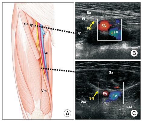 Femoral Nerve Block Versus Adductor Canal Block For Analgesia After