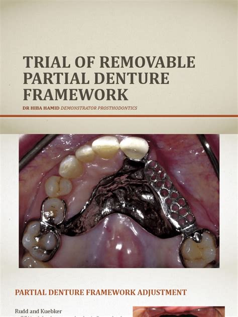 Trial Of Removable Partial Denture Framework Pdf