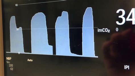 Normal Endtidal Capnography Youtube