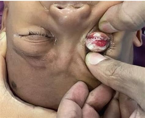 Pseudomembrane Formation Over Palpaebral Conjunctiva Download