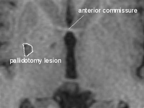 postoperative mri with segmented pallidotomy lesion after reformatting download scientific