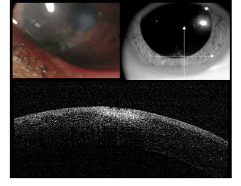 Spectral Domain Anterior Segment Optical Coherence Tomography Images Download Scientific
