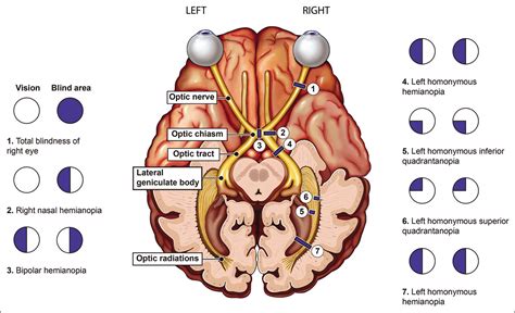 Imaging Of The Primary Visual Pathway Based On Visual Deficits
