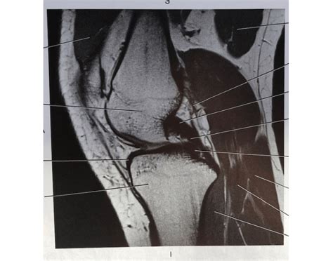 Sagittal T1 Mri Quiz