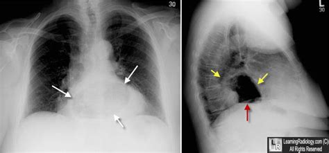 Large Hiatal Hernia Hiatal Hernia Ltdibw
