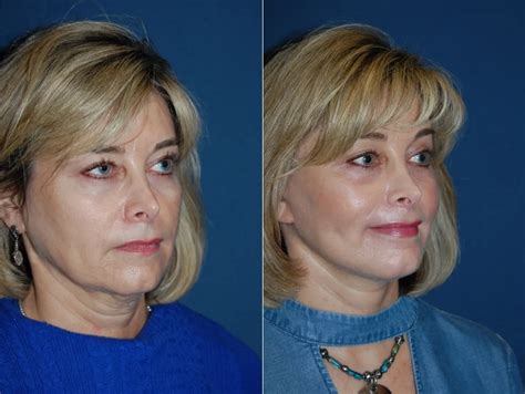 What Causes Joker Smile After Facelift Only Faces