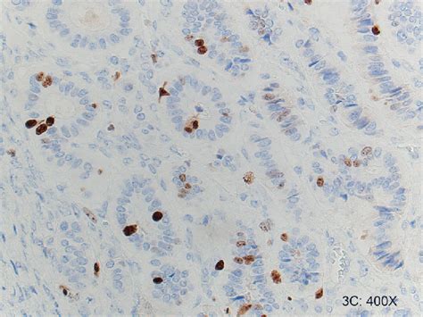 C Ki 67 Proliferation Index 10 In Neuroendocrine Component 3c 400x