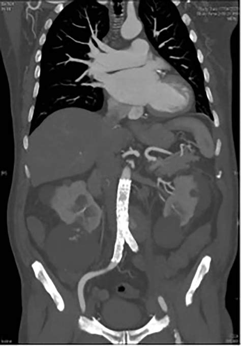 Ct Angiography Post Endovascular Repair Demonstrates An Aorto Bi Iliac Download Scientific