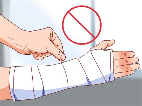 How To Apply A Cast To A Broken Arm 14 Steps With Pictures