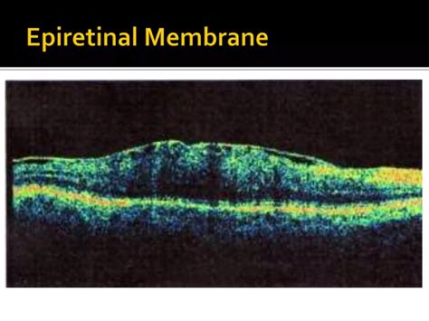 OCT Introduction And Macular Disorders PPTX