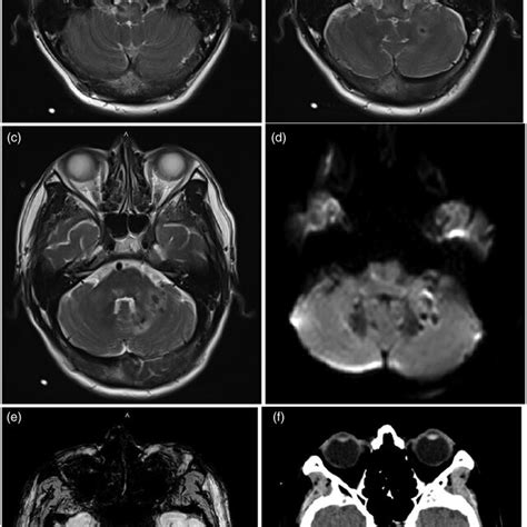 Brain Imaging Of A Patient With Listeria Monocytogenes Download