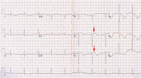 Takotsubo Cardiomyopathy Ecg Book