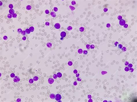 Premium Photo Chronic Myeloid Leukemia Cells Or Cml Analyse By Light Microscope Original