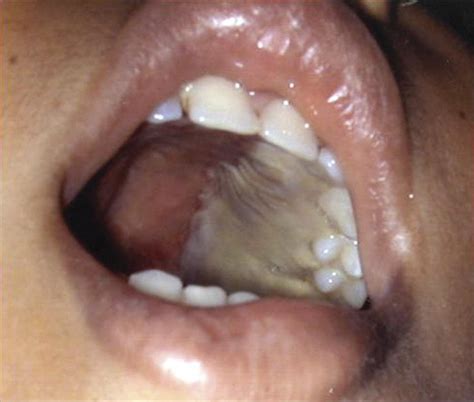 Necrotizing Stomatitis Observed Clinical Signs Of Ppr A Erosive And
