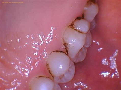All The Different Types Of Teeth Stains 1311 Jackson Ave Dental Dentist In Long Island City NY