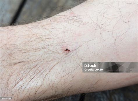 남자는 사슴 또는 검은 다리 진드기 물린 그의 다리에 Ixodes 견갑골 물린 및 라임 또는 보렐리아 질병에 의해 감염 될 위험