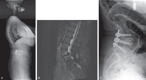 Adjacent Segment Disease After Fusion Neupsy Key