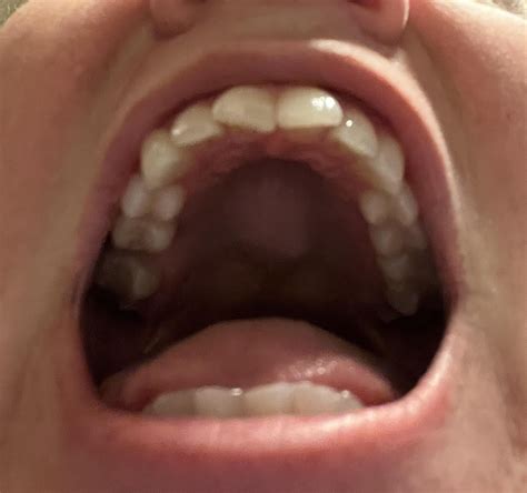 Pre Correction R Invisalign