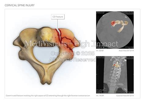 Cervical Fracture Illustration Medivisuals High Impact