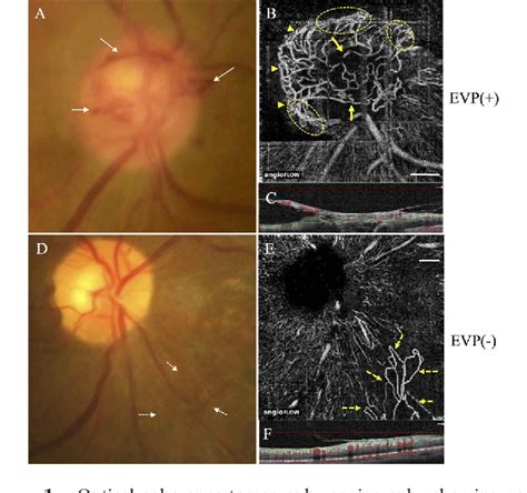 Proliferative Diabetic Retinopathy Neovascularization