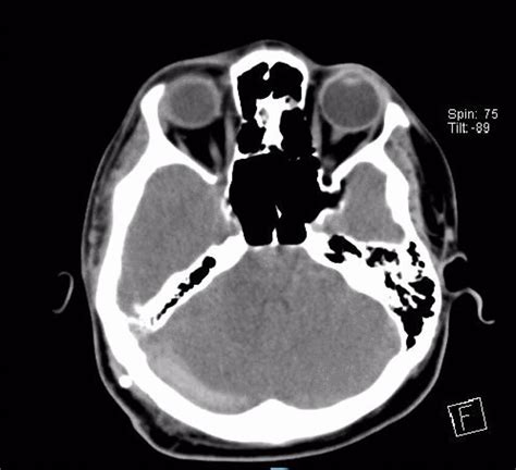 Brain Computed Tomography On The First Day After Readmission Showing Download Scientific