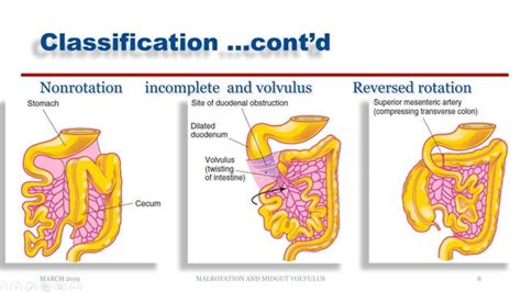 Malrotation And Midgut Volvulus Final Pdf