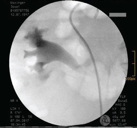 A Ureteral Stricture On Retrograde Pyelogram B Insertion Of A Download Scientific Diagram