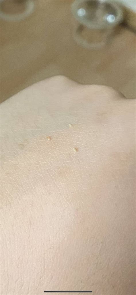 이런 여드름 많이 생기면 뭐가 문제인거야 피지사진 인스티즈instiz 일상 카테고리