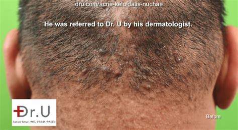 Akn Patient Results Dr U Hair And Skin Clinic Fue Hair Restoration Dermatology And Laser