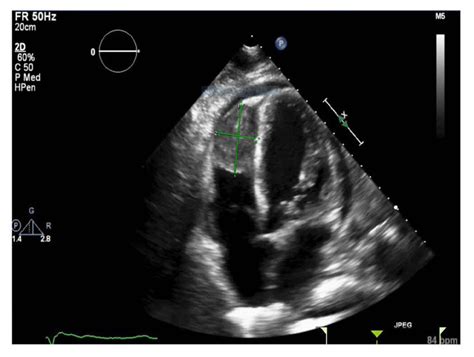 Echocardiogram Transthoracic Tte Download Scientific Diagram