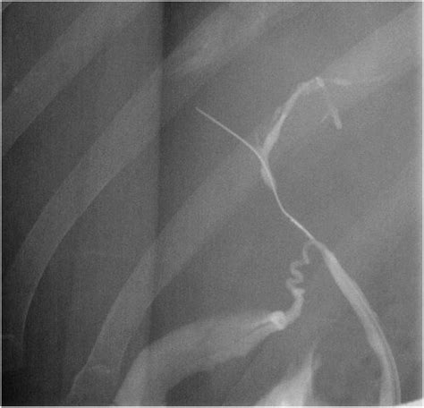 ERCP Image Showing Common Hepatic Duct Stricture And Nonfilling Of The Download Scientific