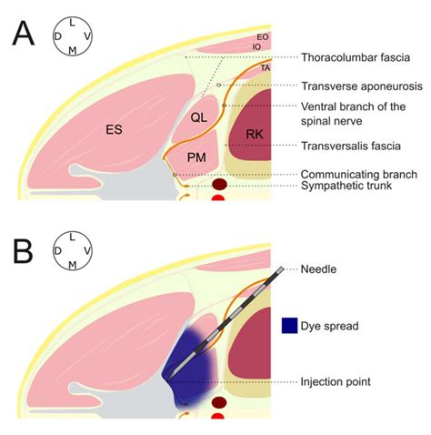 Evaluation Of High Volume Injections Using A Modified Dorsal Quadratus