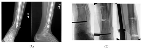 Open Tibia Fracture