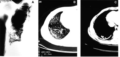 Chest Radiograph And Ct Scan Of A Patient With Diffuse Nodular Download Scientific Diagram
