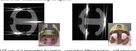 Figure 1 From Metal Artifact Reduction By Fusion Of Ct Scans From Different Positions Using The