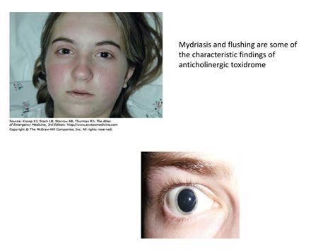 Ppt Anticholinergic Syndrome By Dr Anjeannette Reece Powerpoint